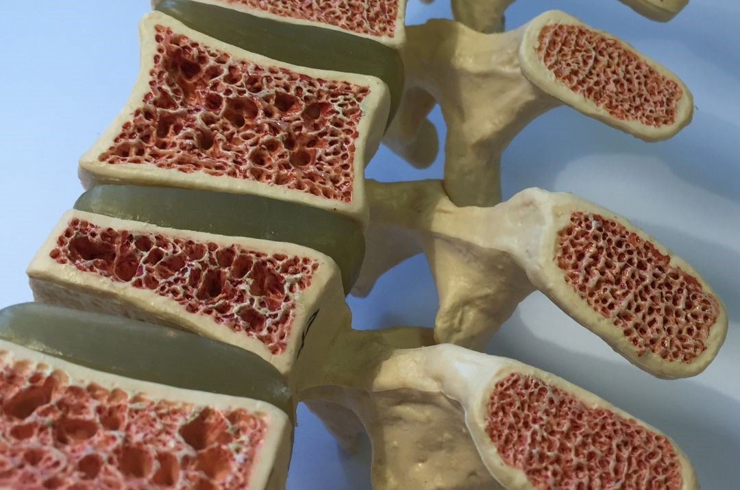 All About Osteoporosis | Chirn Park Health Group